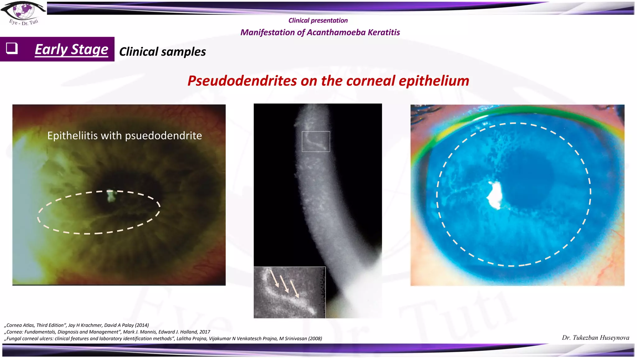Akanthomoeba Keratitis.pdf