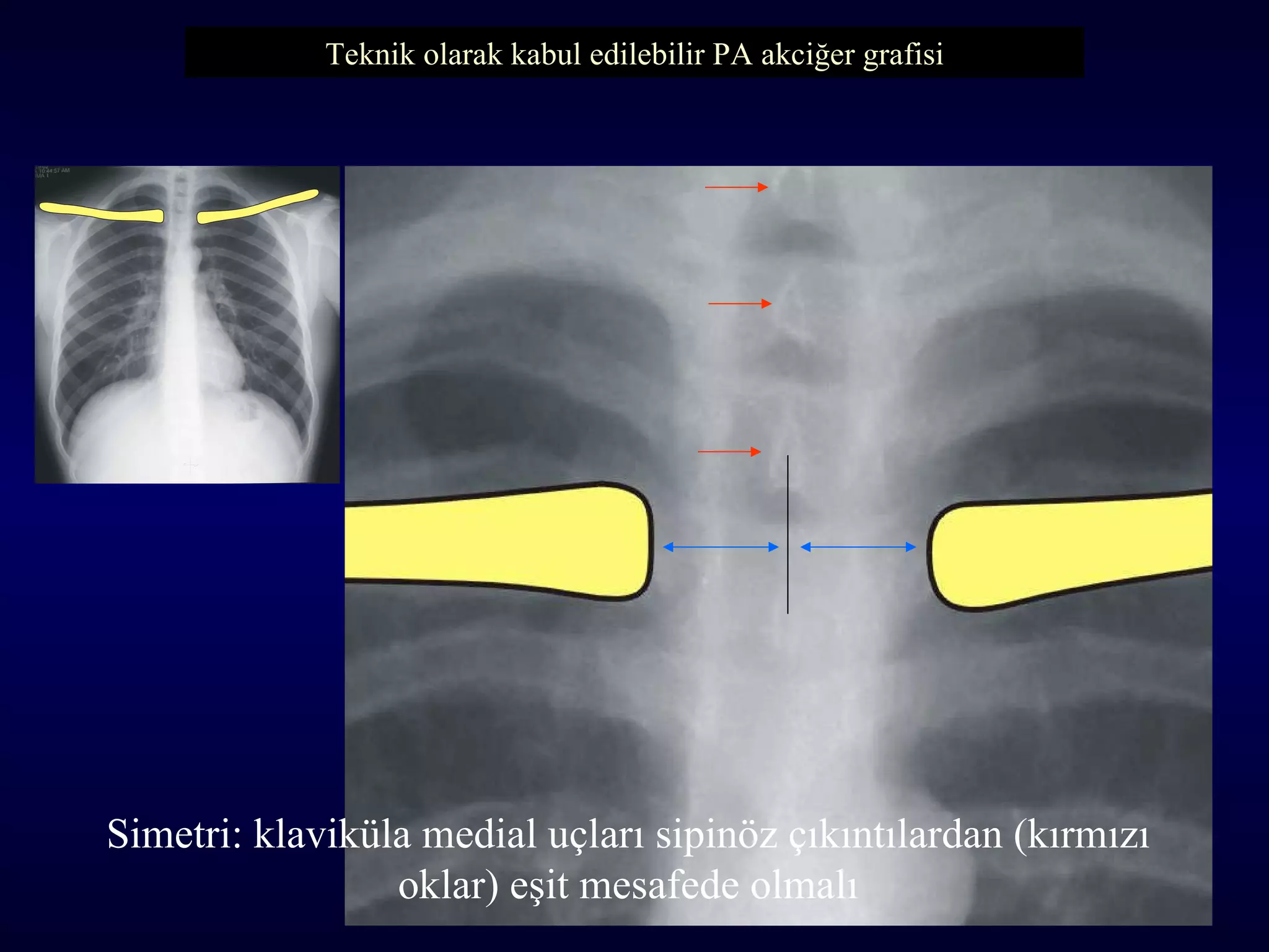 Akciğer grafisi (fazlası için www.tipfakultesi.org) | PPT