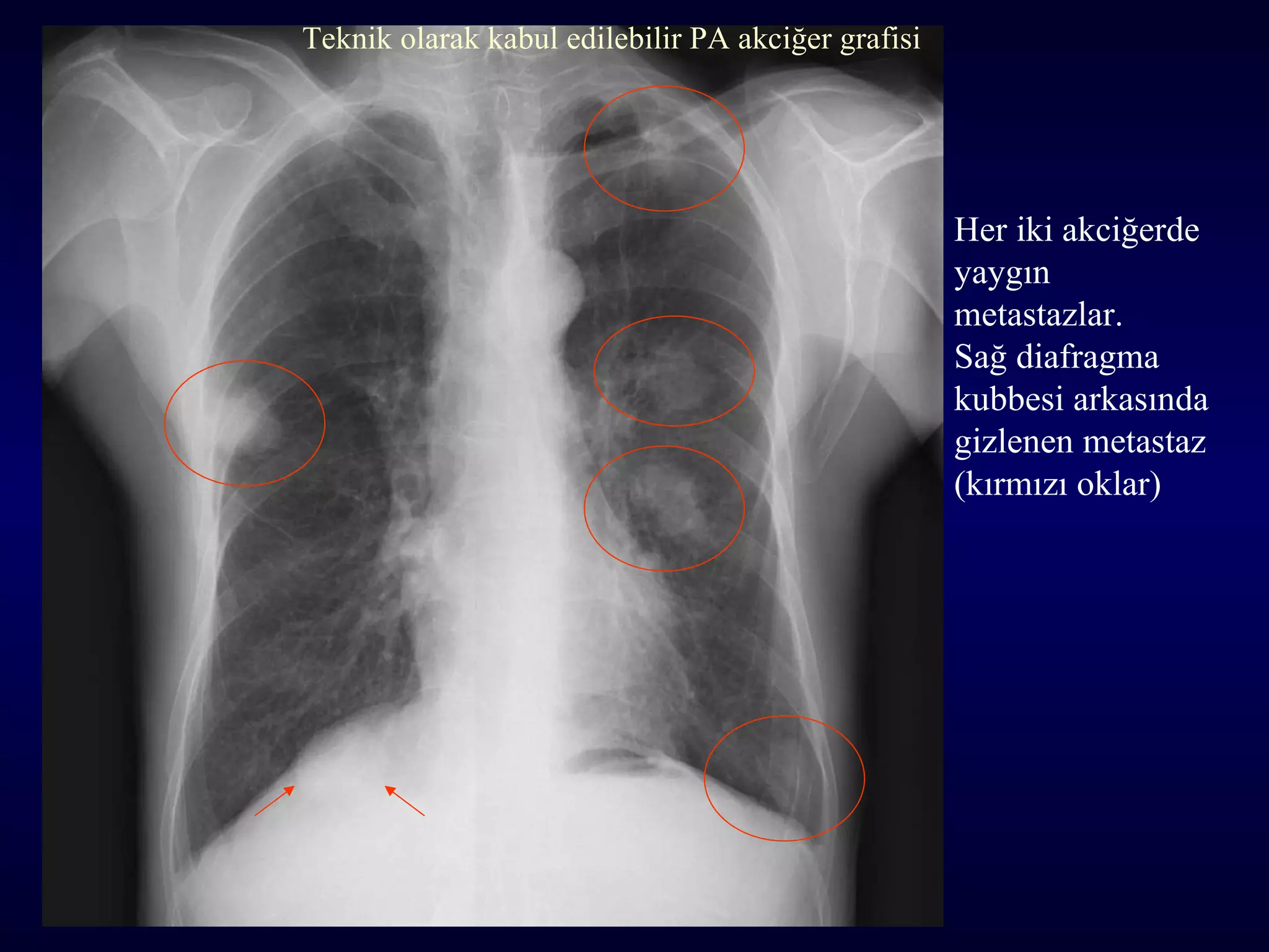 Akciğer grafisi (fazlası için www.tipfakultesi.org) | PPT