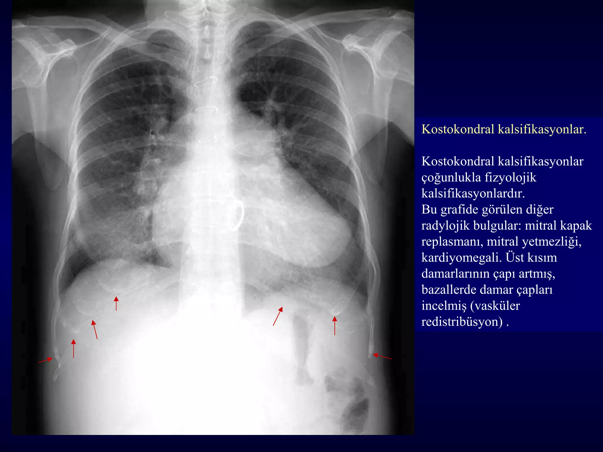 Akciğer grafisi (fazlası için www.tipfakultesi.org) | PPT