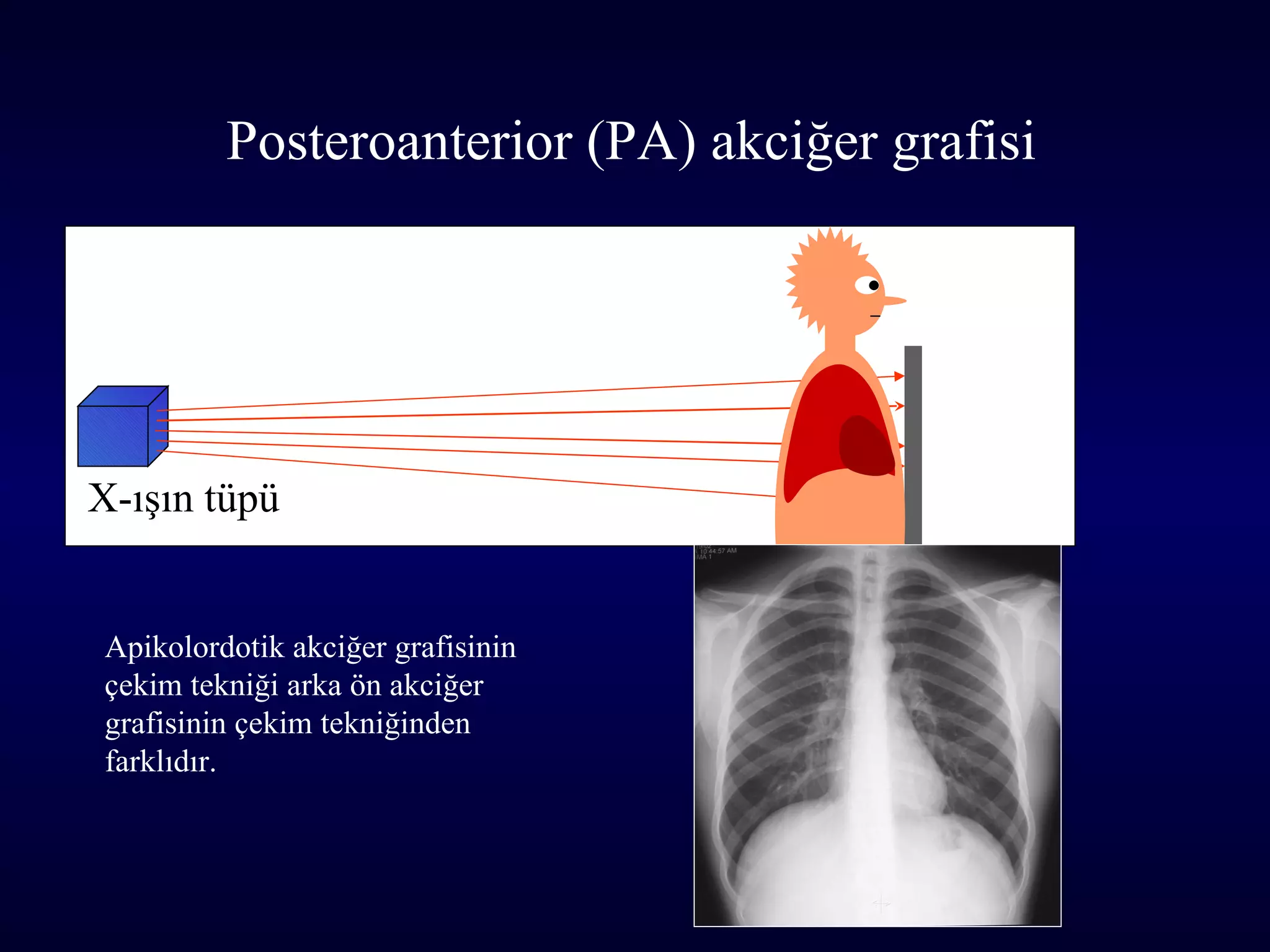 Akciğer grafisi (fazlası için www.tipfakultesi.org) | PPT