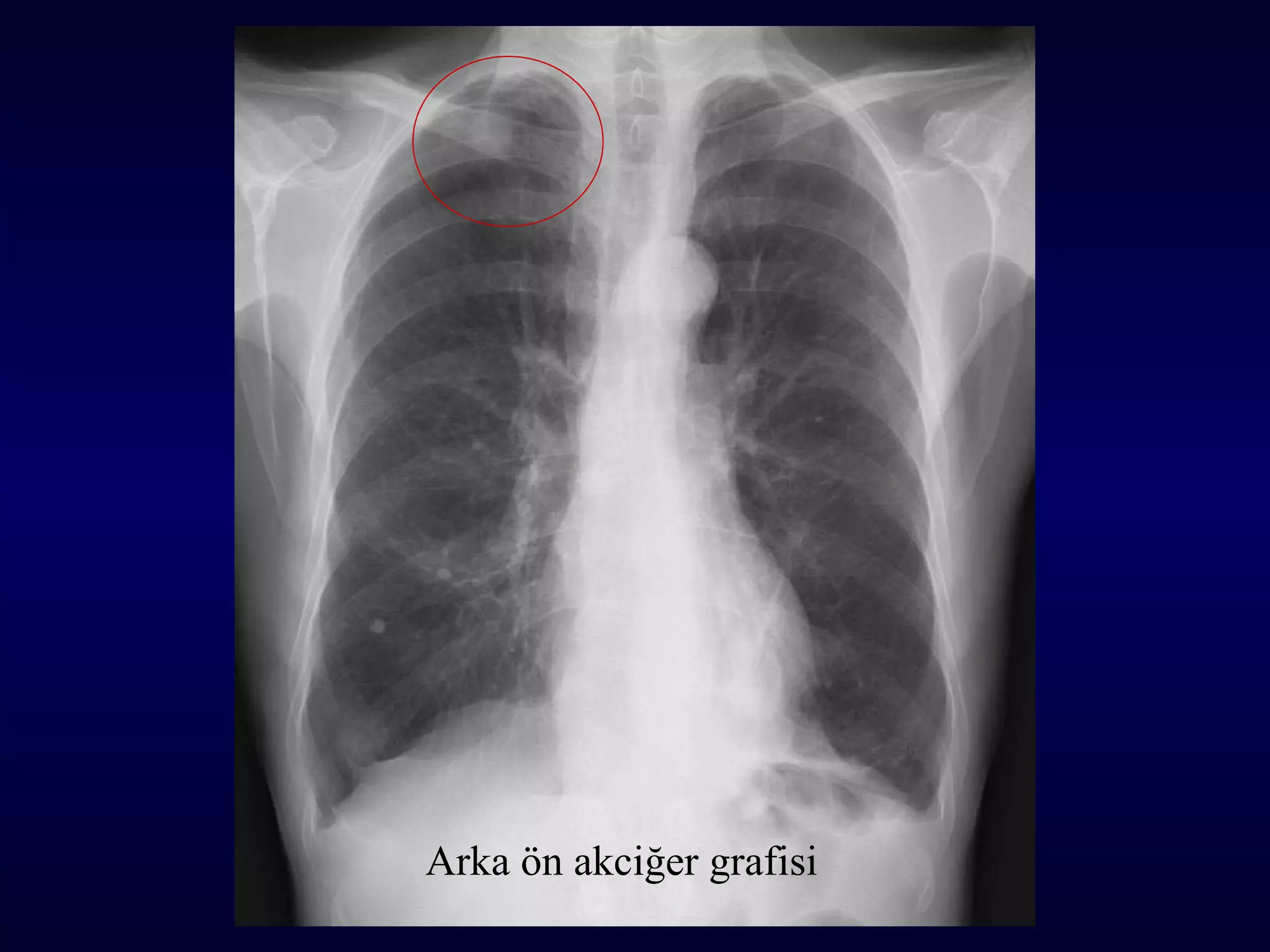 Akciğer grafisi (fazlası için www.tipfakultesi.org) | PPT