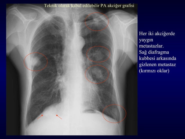 Akciğer grafisi (fazlası için www.tipfakultesi.org) | PPT