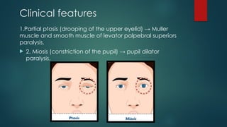 horners syndrome medicine and surgery ppt | PPTX