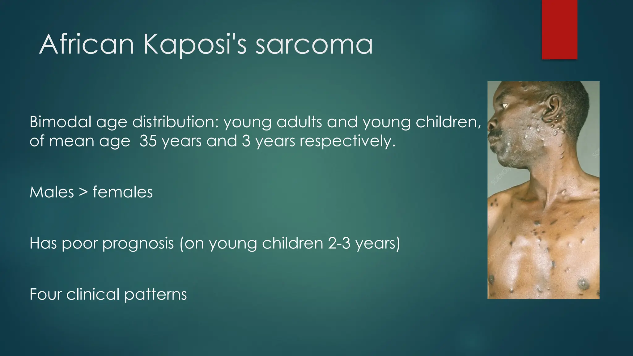 Kaposi's sarcoma medicine and surgery ppt | PPTX