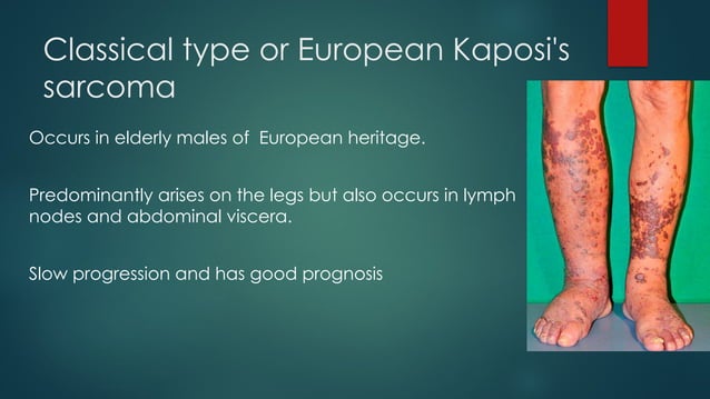 Kaposi's sarcoma medicine and surgery ppt | PPTX
