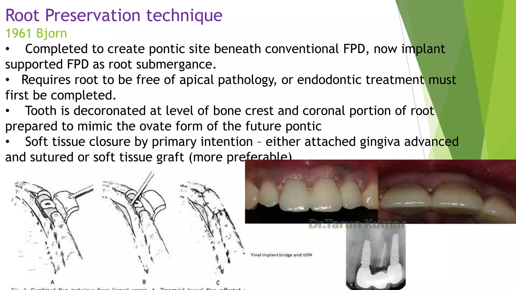 Recent Advances in Implanty Dentistry | PPTX