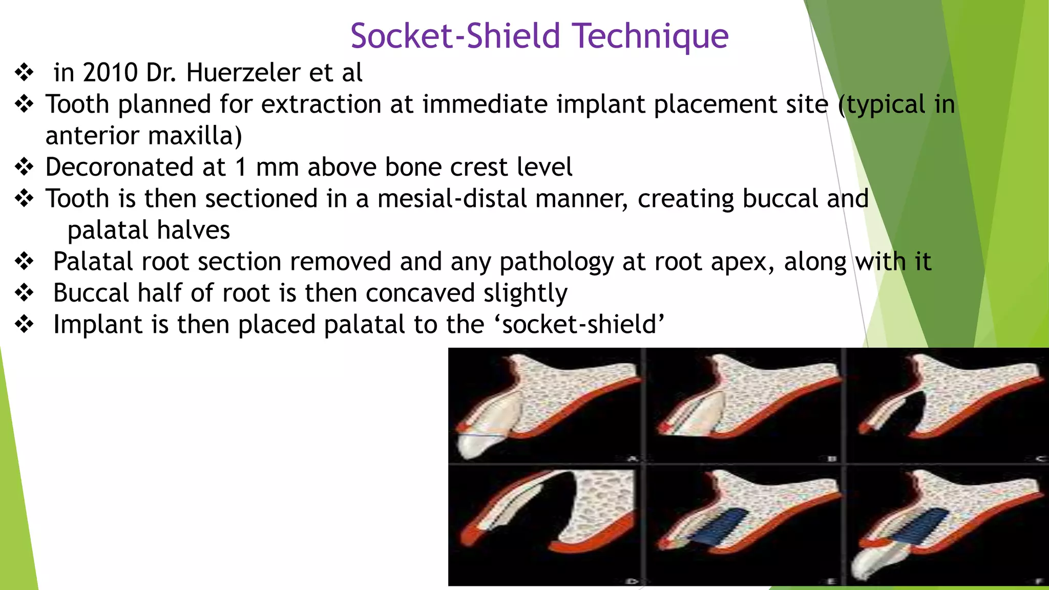Recent Advances in Implanty Dentistry | PPTX