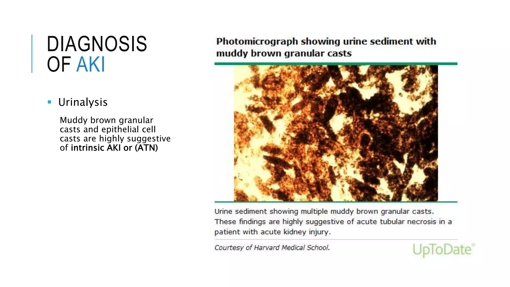 pediatric Acute Kidney Injury - AKI | PPTX