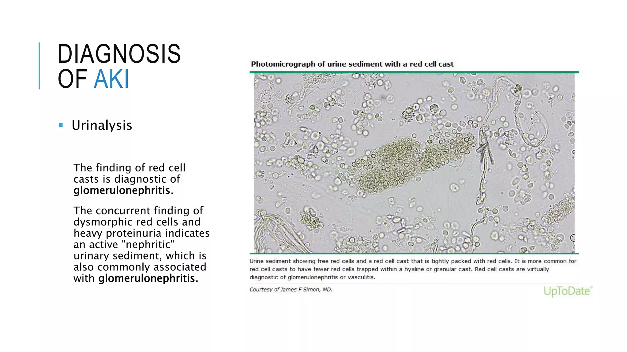 pediatric Acute Kidney Injury - AKI | PPTX