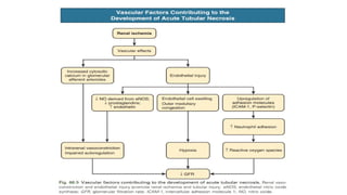 Acute kidney injury - mechanism and types | PPTX