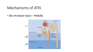 Acute kidney injury - mechanism and types | PPTX