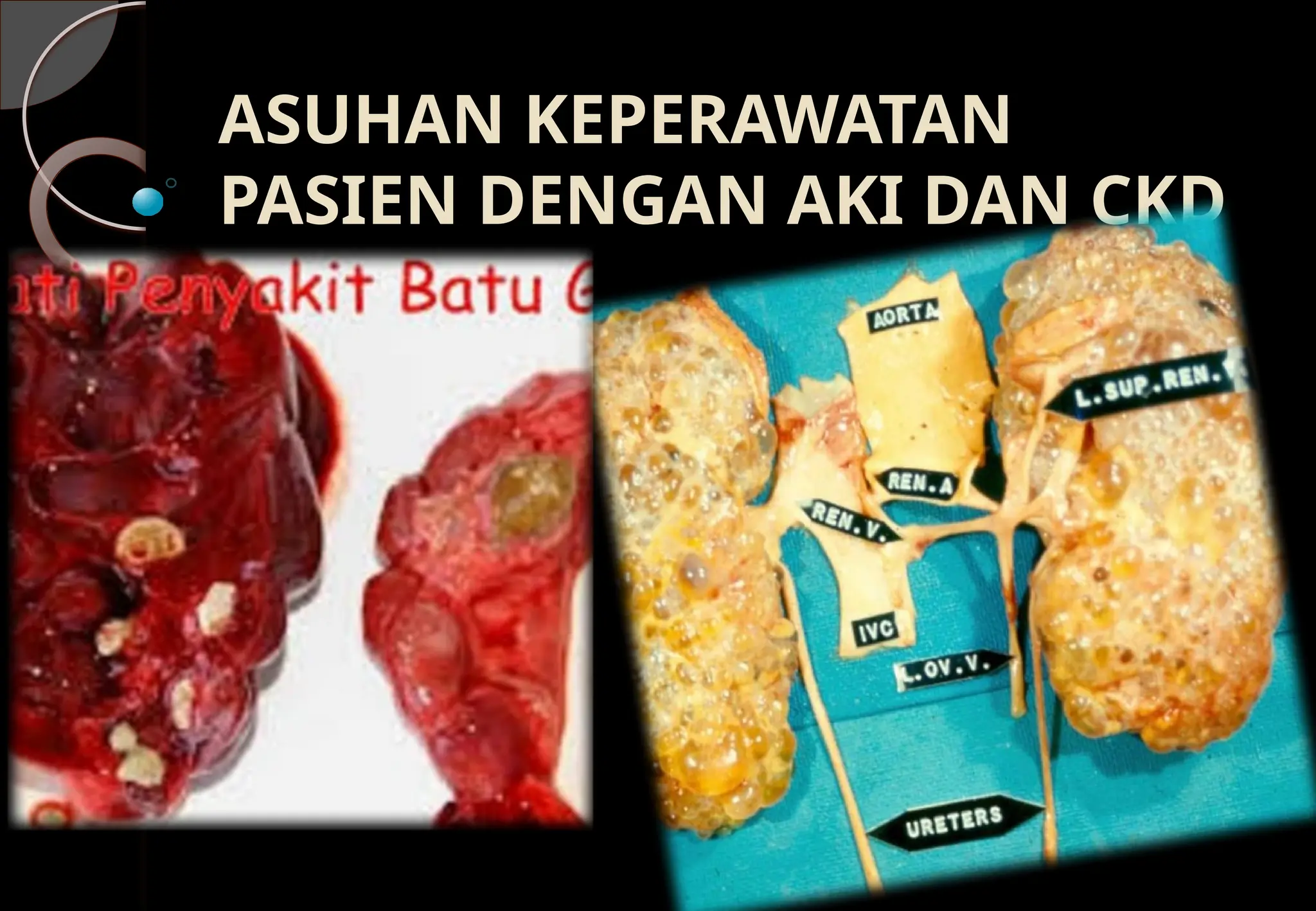 ASUHAN KEPERAWATAN PADA PASIEN AKI DAN CKD | PPTX