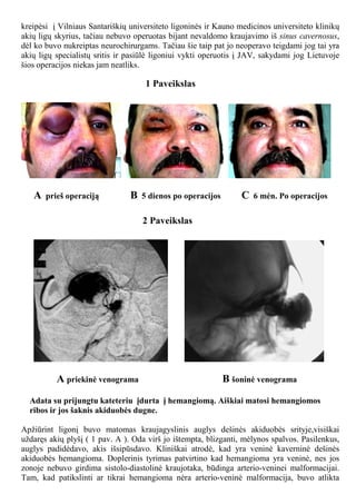 Sėkmingai chirurgiškai išgydytas akiduobės kraujagyslinis auglys ...