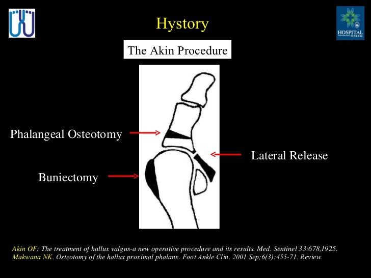 Osteotomia de Akin asociada a otras técnicas para el tratamiento del