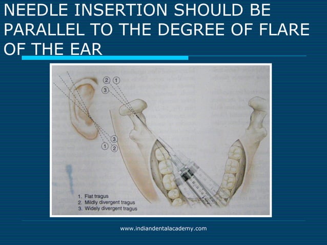 Akinosi & gow gates nerve blocks / prosthodontic courses | PPT | Ear ...