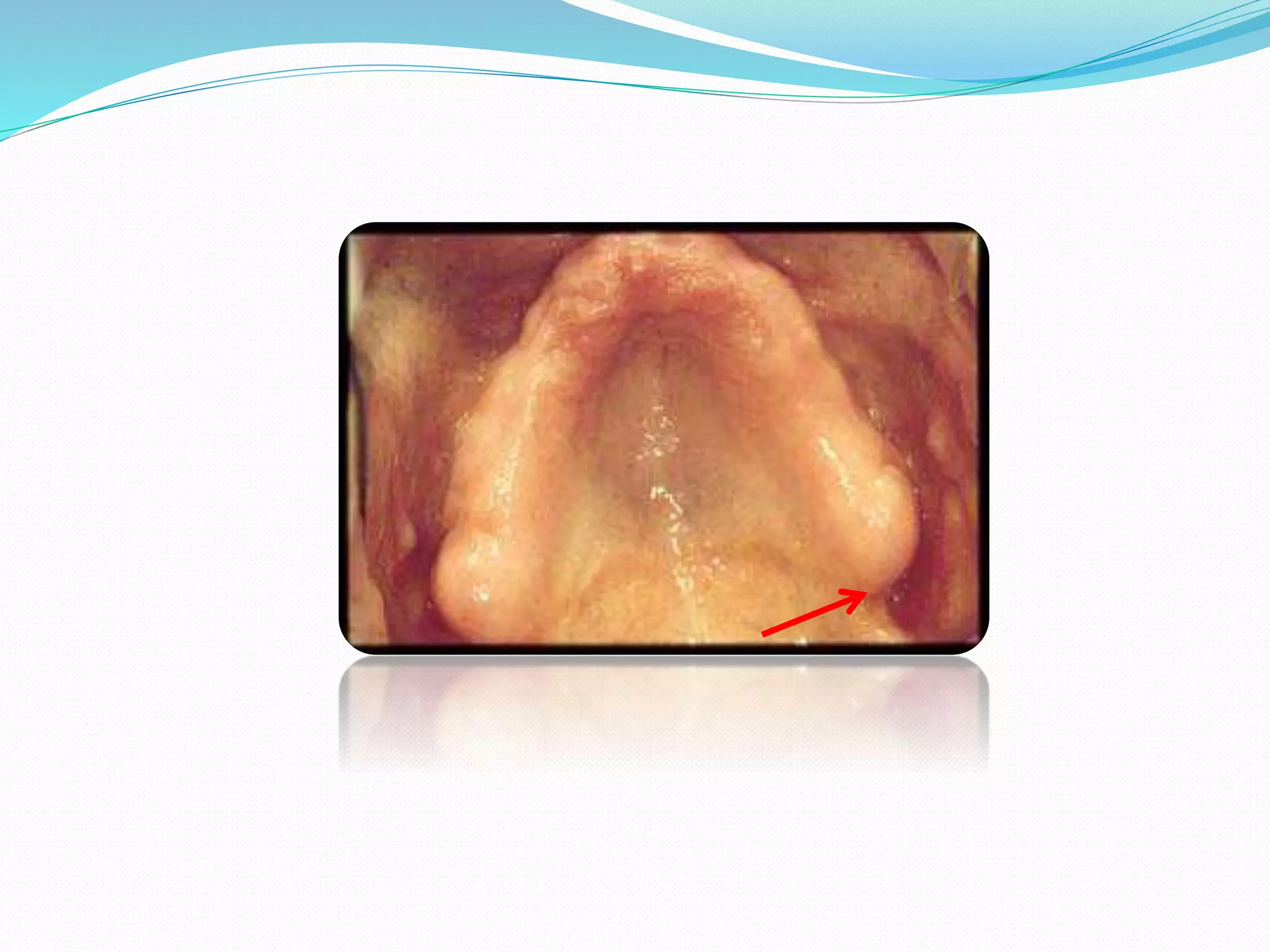 maxillary anatomical landmarks | PPTX