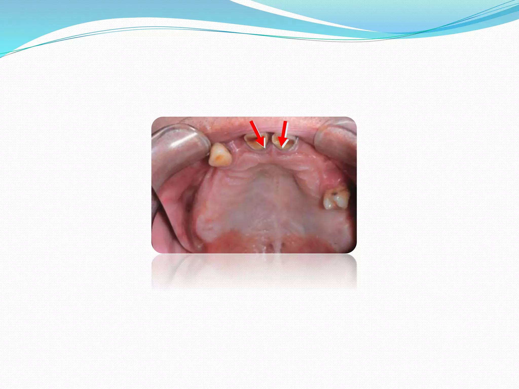 maxillary anatomical landmarks | PPTX