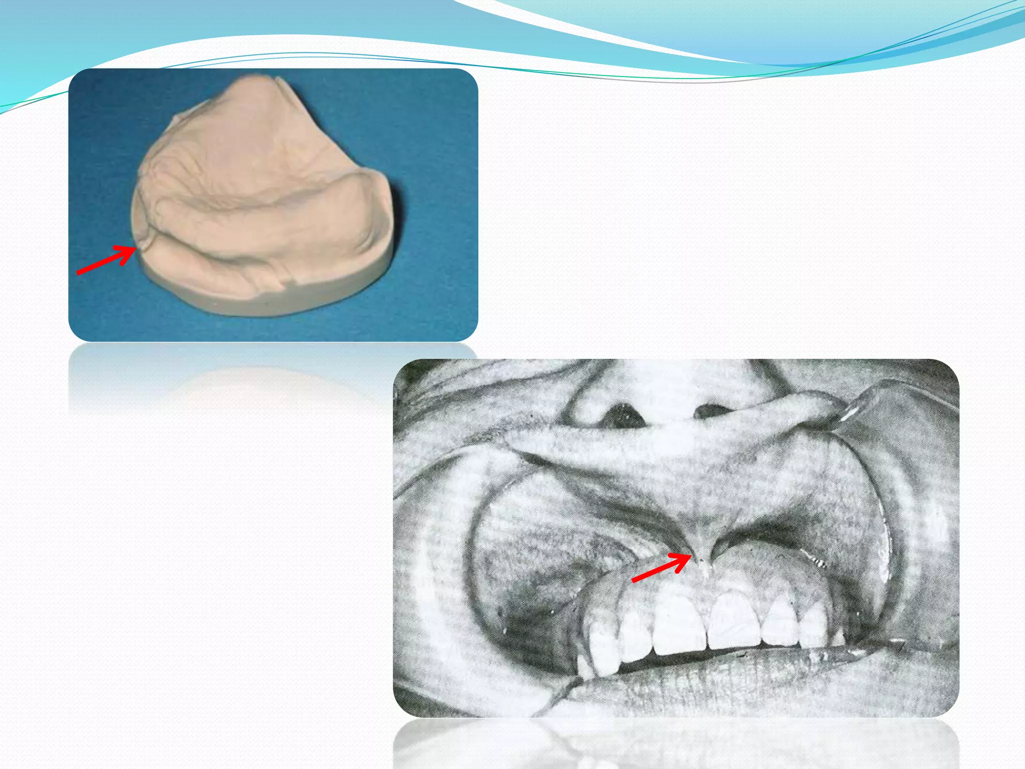 maxillary anatomical landmarks | PPTX