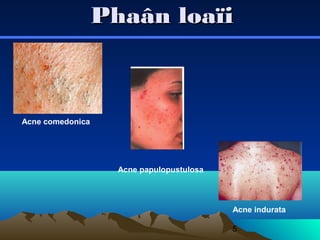 Akne mun trung_ca | PPT