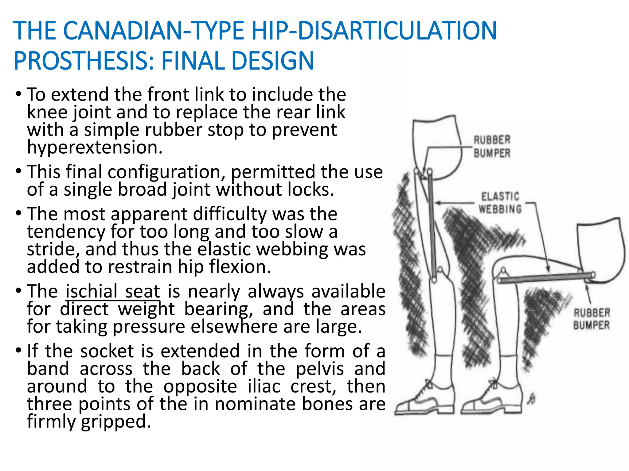 HIP DISARTICULATION | PPTX