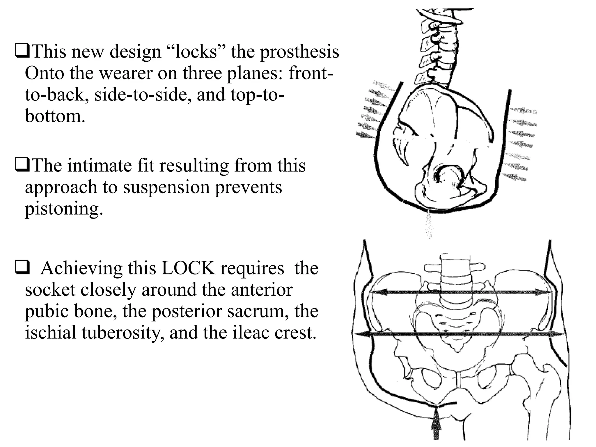 HIP DISARTICULATION | PPTX
