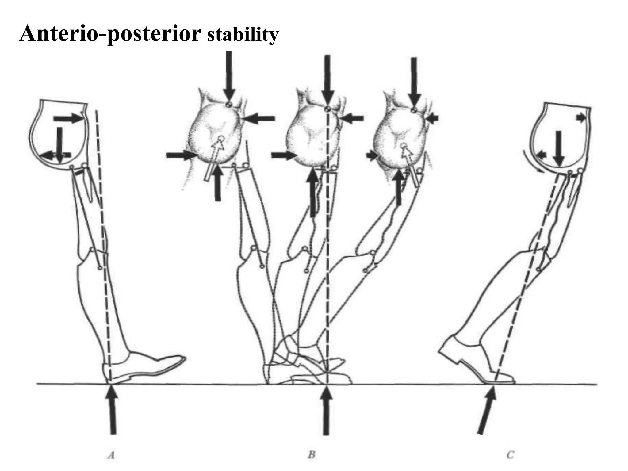 HIP DISARTICULATION | PPTX