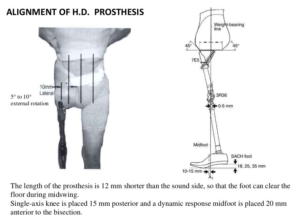 HIP DISARTICULATION