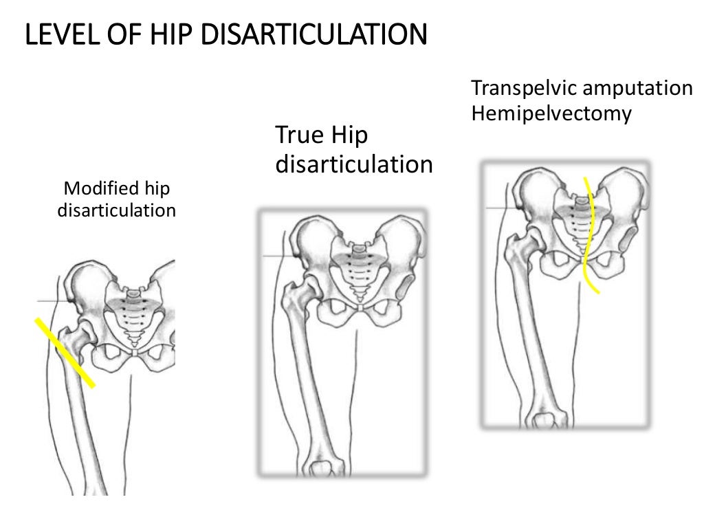HIP DISARTICULATION