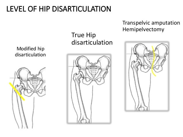 HIP DISARTICULATION