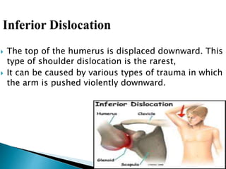 shoulder dislocation orthopedics + glenohumeral dislocation and ...