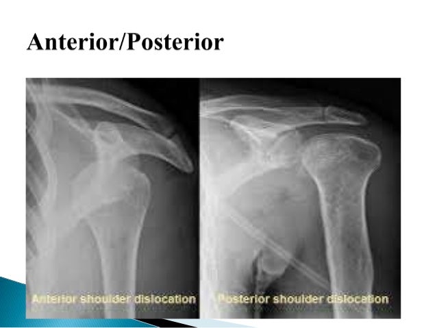 shoulder dislocation orthopedics + glenohumeral dislocation and man…