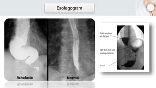 Aksi achalasia esofagus | PPTX