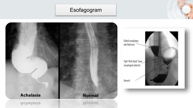 Aksi achalasia esofagus | PPTX
