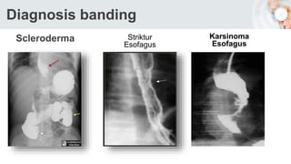 Aksi achalasia esofagus | PPTX