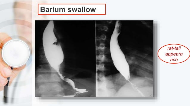 Aksi achalasia esofagus | PPTX