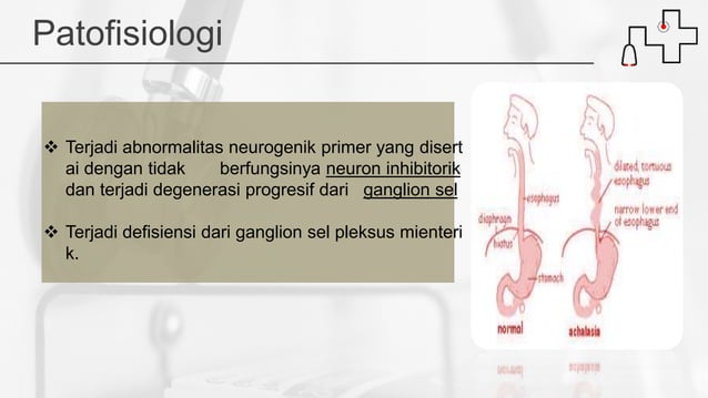 Aksi achalasia esofagus | PPTX