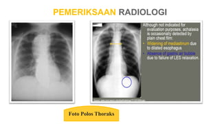 Aksi achalasia esofagus | PPTX