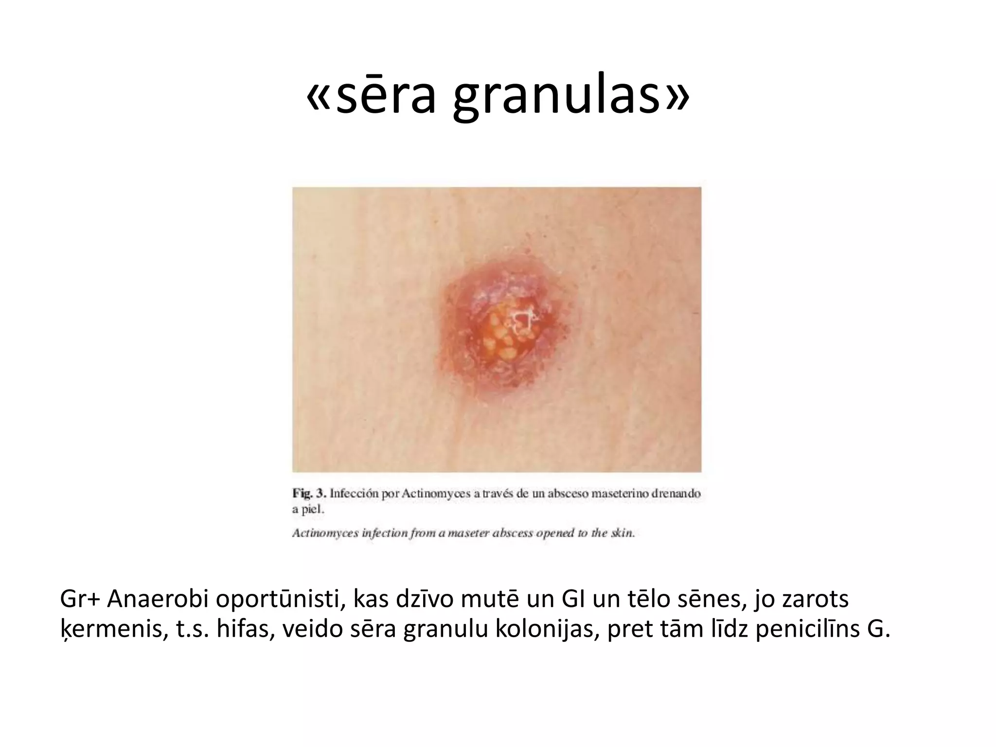 Aktinomikozes mikrobioloģiskā diagnostika (2) | PPTX