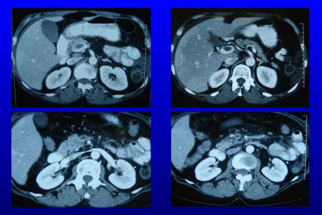 Akut mezenter iskemi