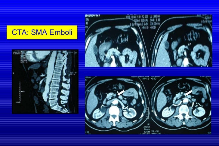 Akut mezenter iskemi