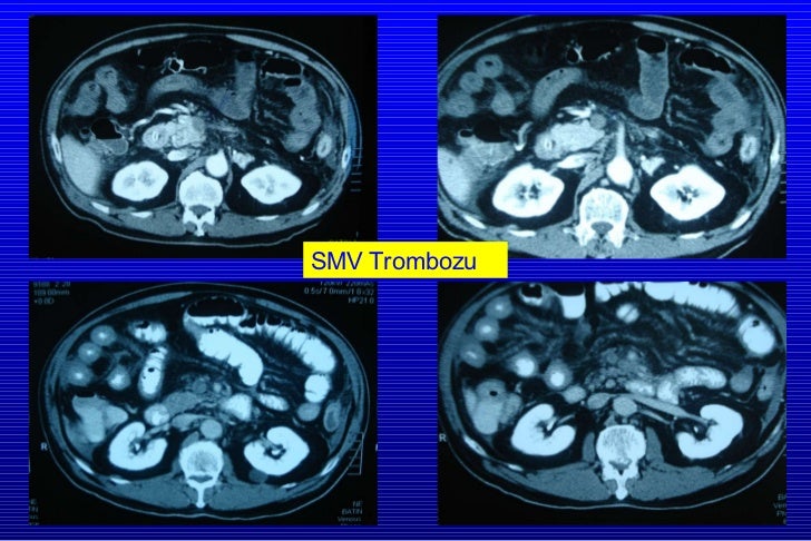 Akut mezenter iskemi