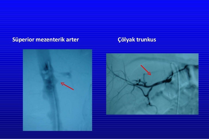 Akut mezenter iskemi