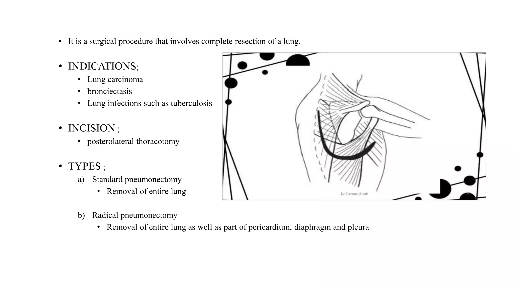 pneumonectomy | PPTX