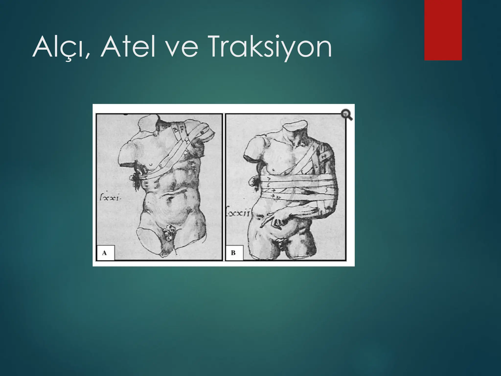 Alçı-Atel-Traksiyon for fracture management.ppt