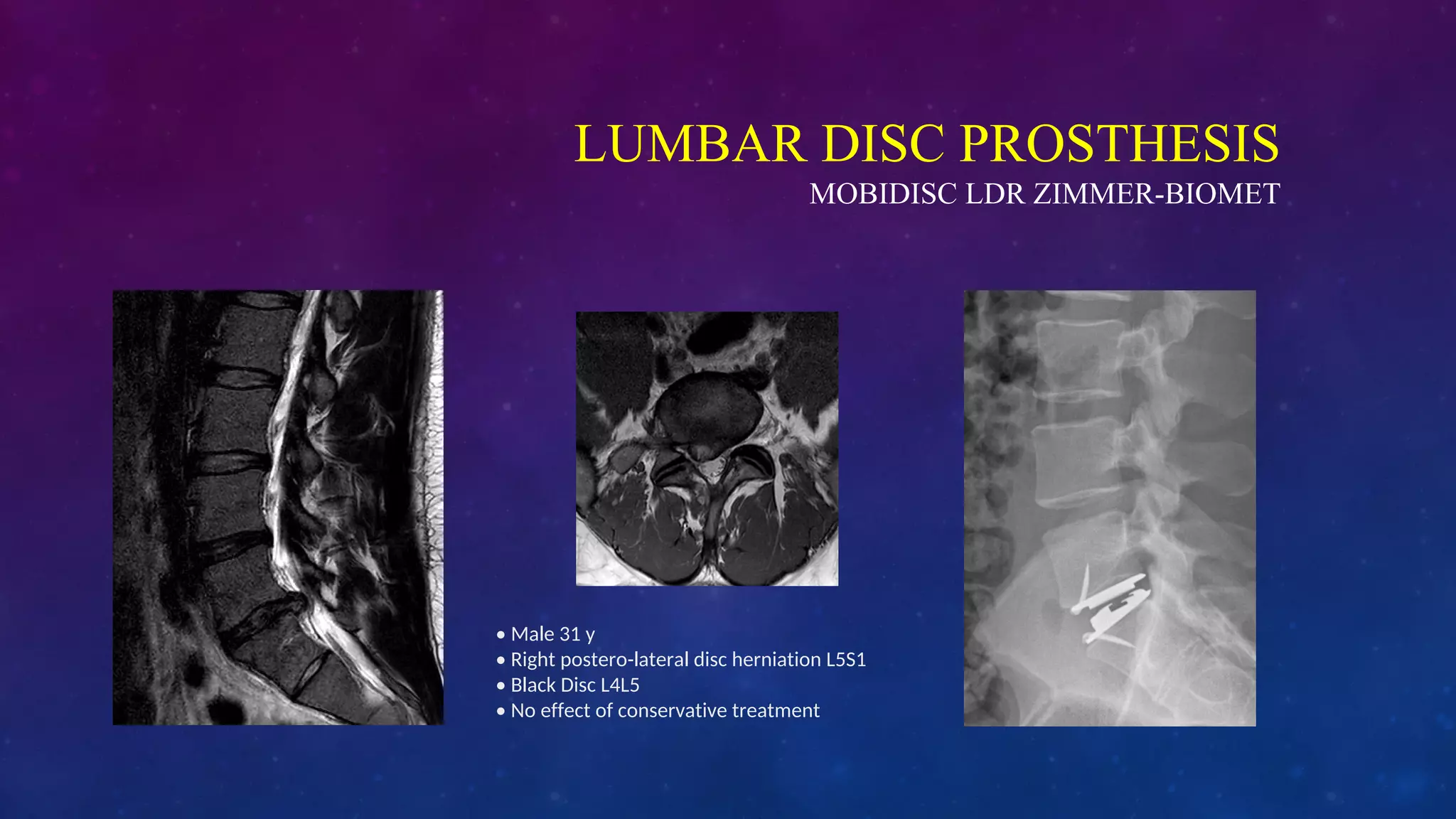 Anterior Lumbar Approach & Lumbar Disc Prosthesis LEFLOT J-L | PDF