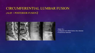 Anterior Lumbar Approach & Lumbar Disc Prosthesis LEFLOT J-L | PDF