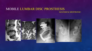 Anterior Lumbar Approach & Lumbar Disc Prosthesis LEFLOT J-L | PDF