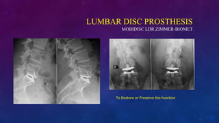 Anterior Lumbar Approach & Lumbar Disc Prosthesis LEFLOT J-L | PDF