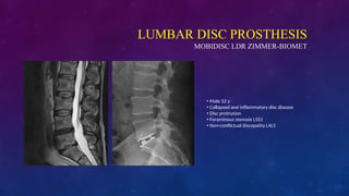 Anterior Lumbar Approach & Lumbar Disc Prosthesis LEFLOT J-L | PDF